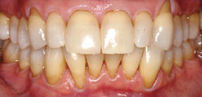Teeth-detection-FDI-System-v2 Object Detection Dataset and Pre-Trained Model by Rizka Milandga