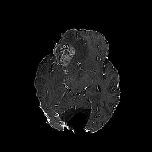 Brain Tumour Detection 8 Object Detection Dataset By Rahul Shiva Konar