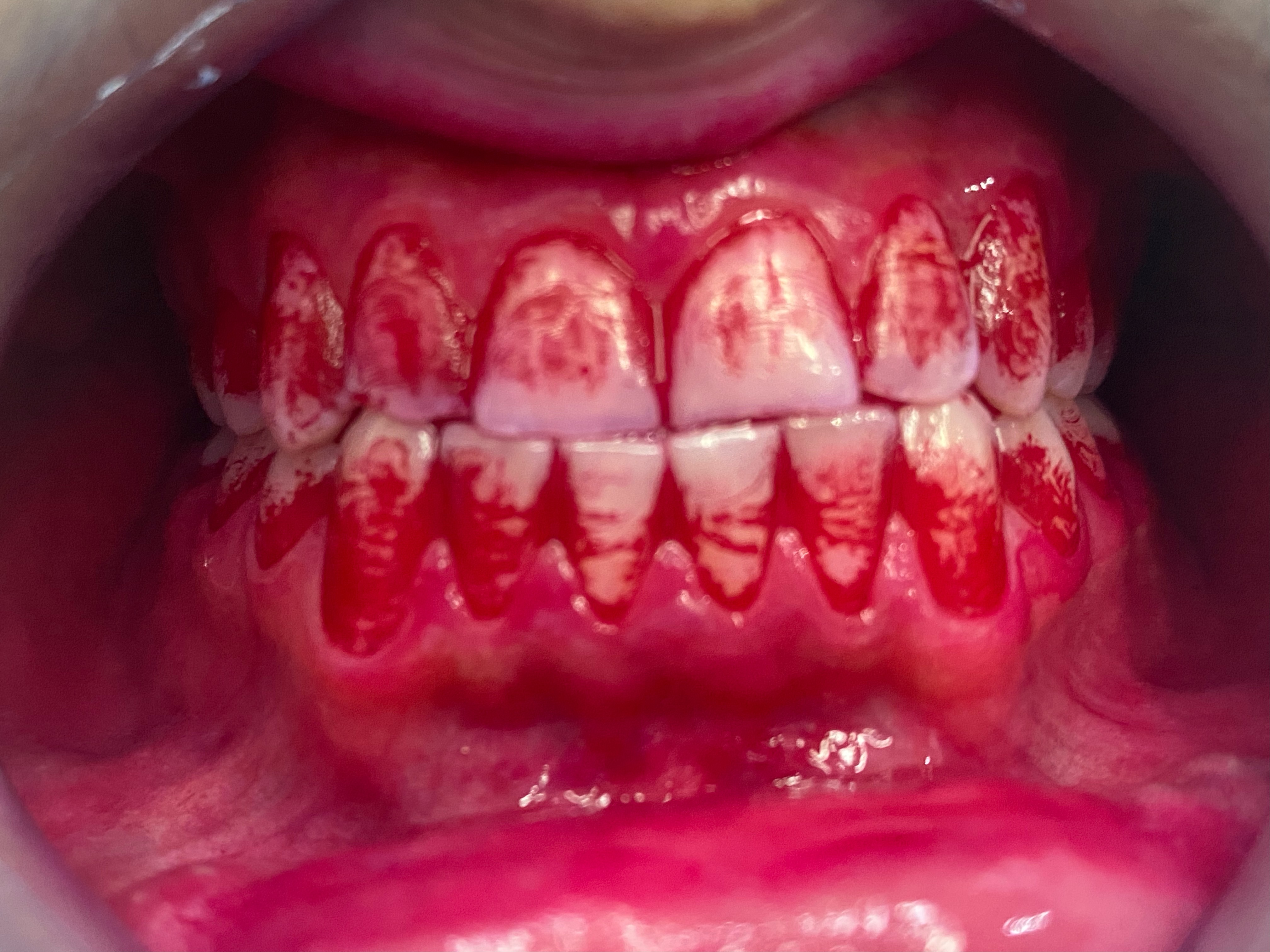 PLAK Semantic Segmentation Dataset by projectDens