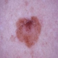 Skin Cancer Detection Classification Dataset and Pre-Trained Model by ...
