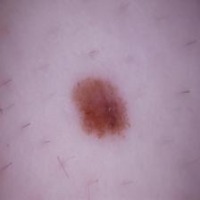 Skin Cancer Detection Classification Dataset and Pre-Trained Model by ...