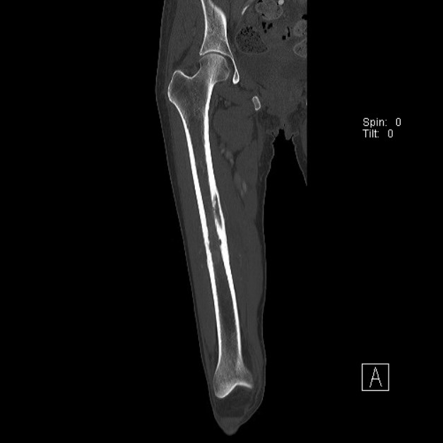 Femur Instance Segmentation Dataset By Final