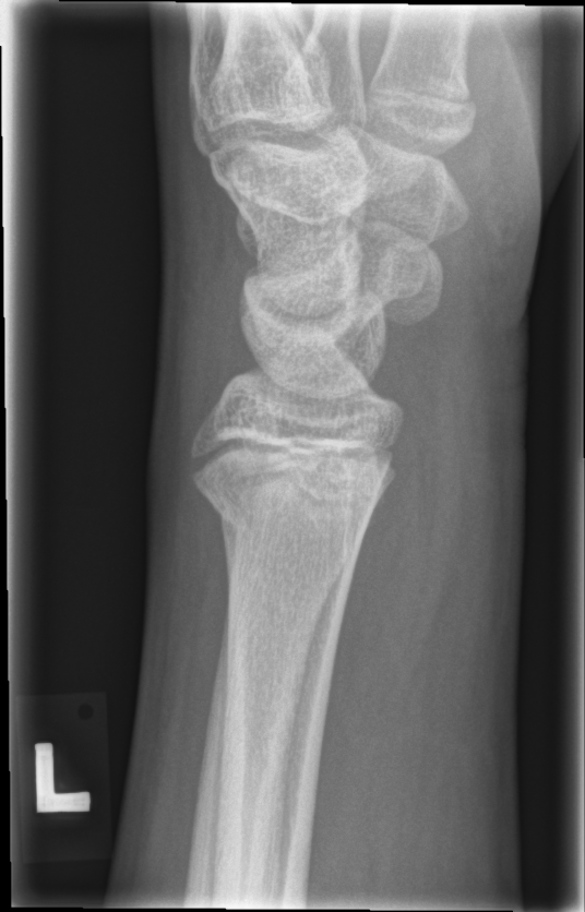 Pediatric Wrist Fractures Object Detection Dataset and Pre-Trained Model by Final