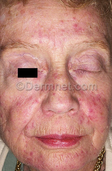 How to Use the facial skin diseases Classification API