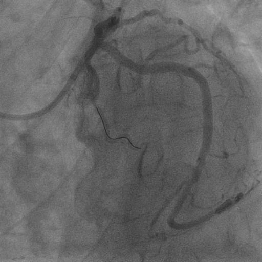 Stenosis Object Detection Dataset By Ulcer Detection