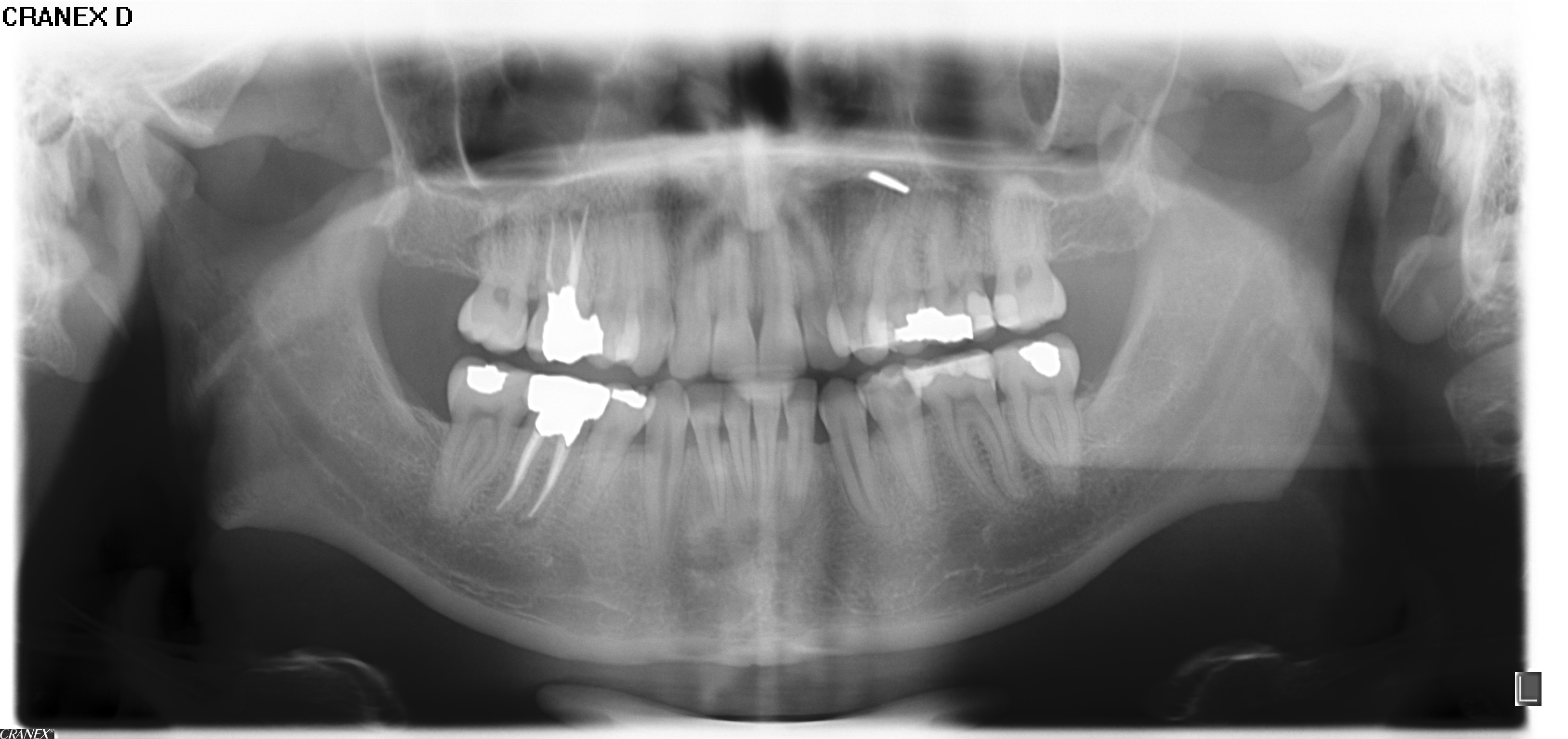 infected teeth Detecting Object Detection Dataset and Pre-Trained Model ...