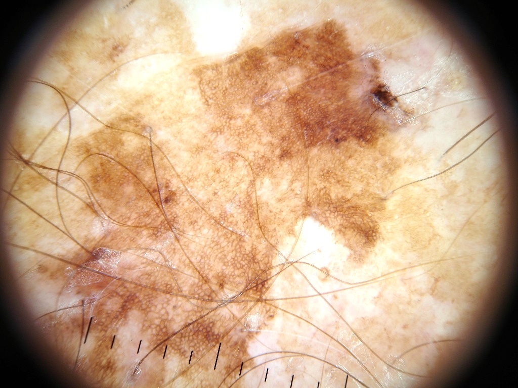 thesis-skin-cancer Classification Dataset by chel