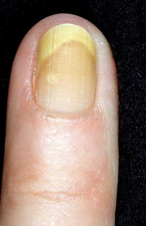 Nail Disease Detection Classification Dataset V2 2023 02 03 12 29am