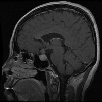 Brain Cancer Detection - MRI Images Classification Dataset and Pre ...