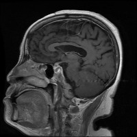 Brain Cancer Detection - MRI Images Classification Dataset and Pre ...