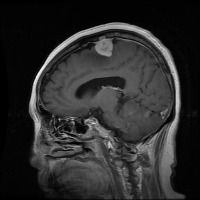 Cancer Detection through MRI scans Object Detection Dataset and Pre ...