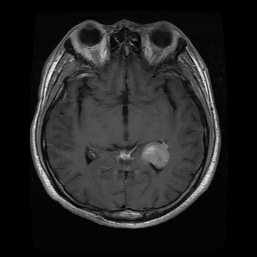 Tumor Detection Object Detection Dataset By Jeremy Kiplagat