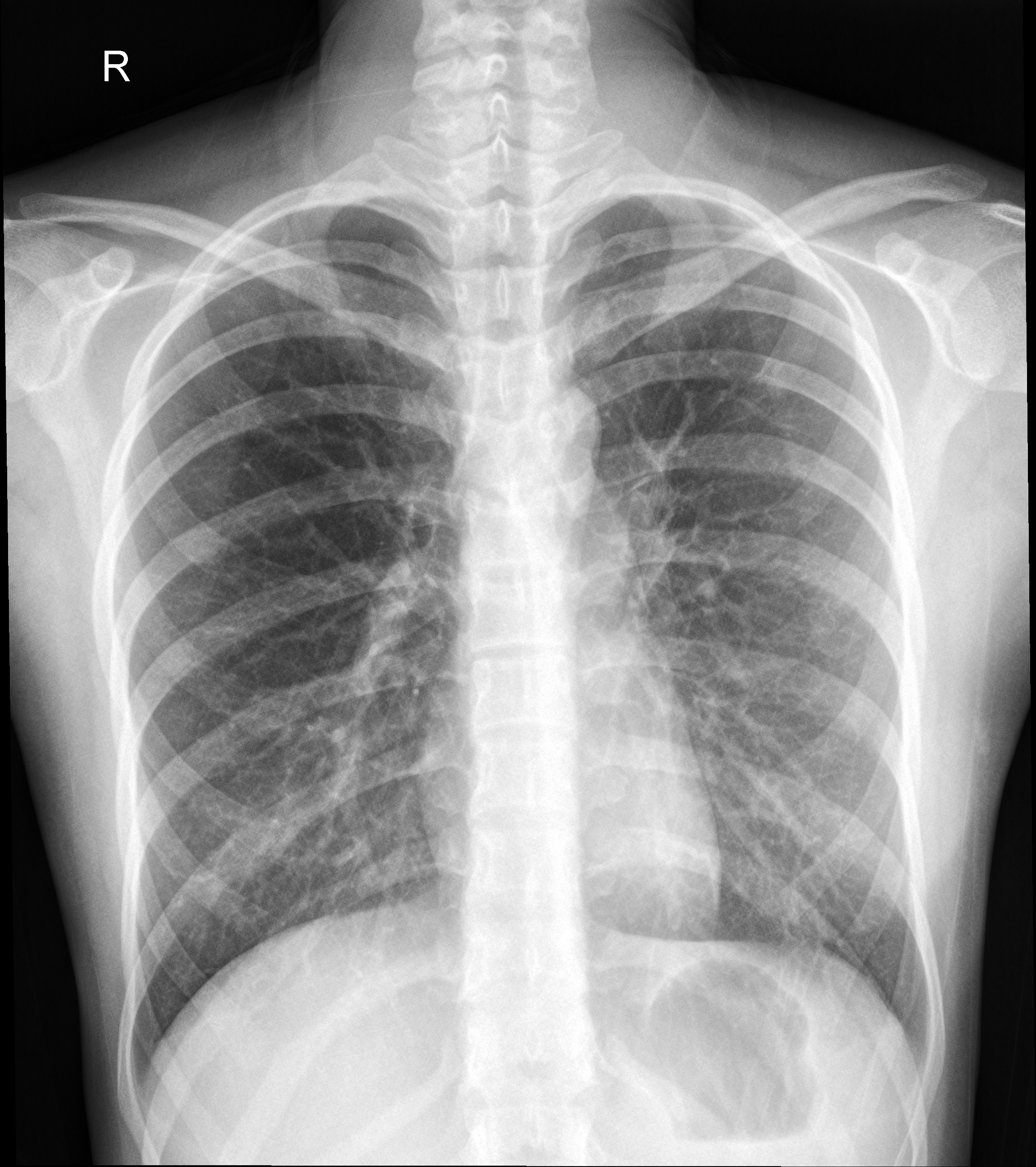 Pneumonia Detection Classification Dataset and Pre-Trained Model by ...