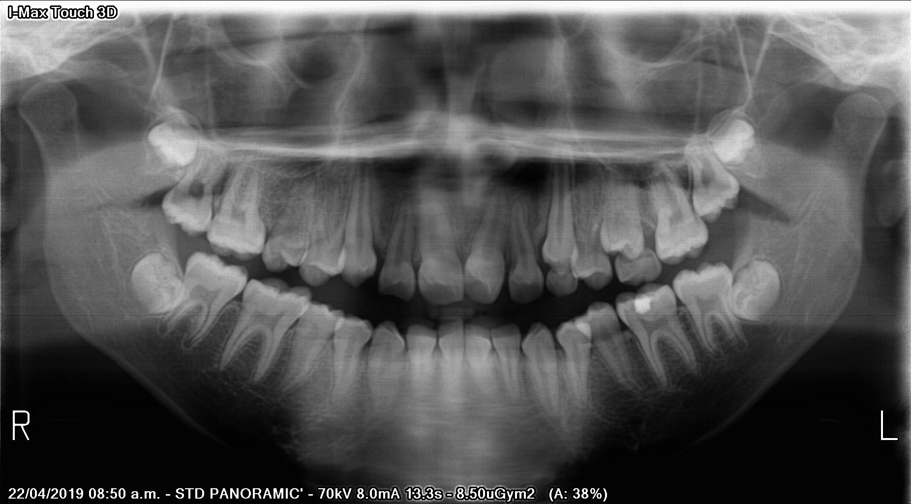 teeth detection and numbering Object Detection Dataset and Pre-Trained Model by Prime