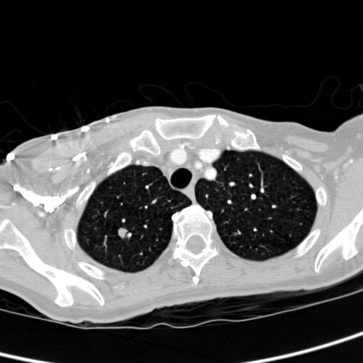 Lung Nodule Detection Object Detection Dataset and Pre-Trained Model by ss