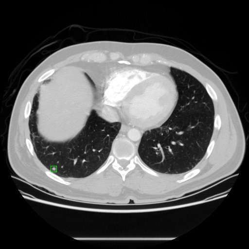 Nodule Detection Object Detection Dataset By Ss