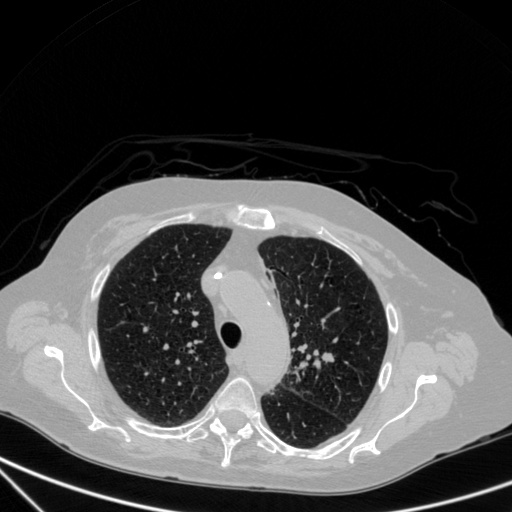 Nodule segmentation Object Detection Dataset by ss