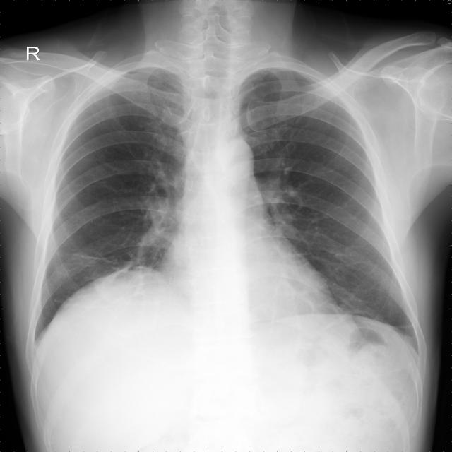 lung Object Detection Dataset and Pre-Trained Model by rp