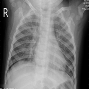 viral-pneumonia-dataset Classification Dataset by ISU