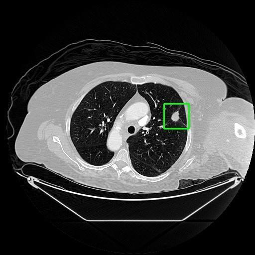 Lung Nodule Detection Extra Object Detection Dataset and Pre-Trained Model by Studio B