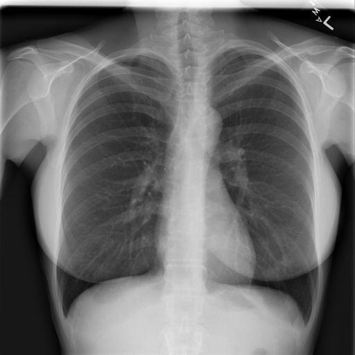 Tuberculosis Semantic Segmentation Dataset and Pre-Trained Model by Fracture Detection