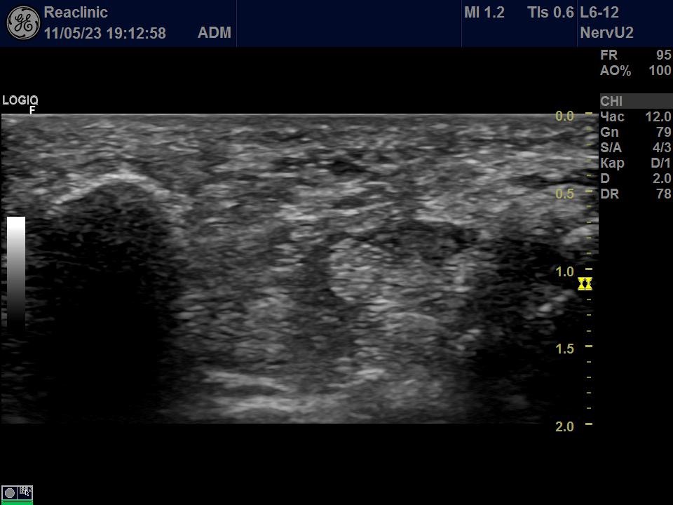 How to Use the Median nerve section Object Detection API