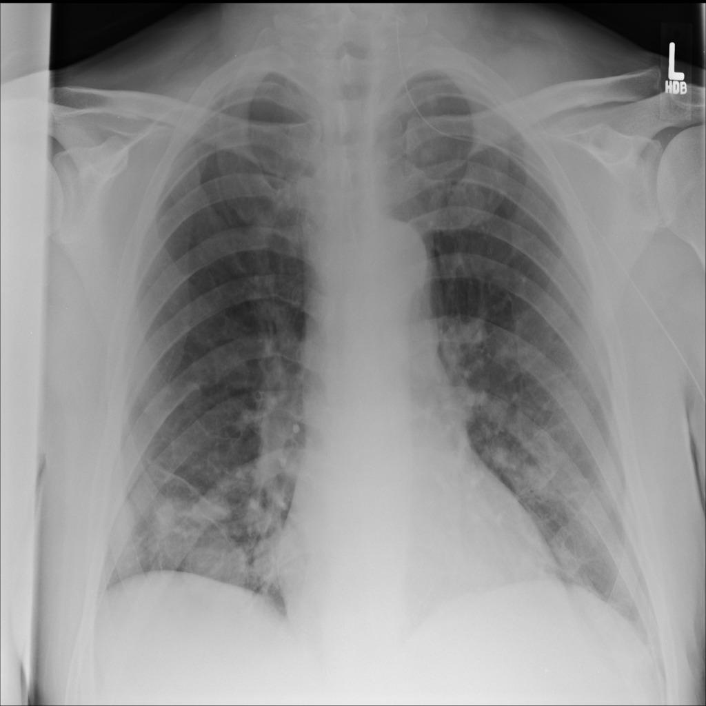 How To Use The Pneumonia Detection Object Detection Api