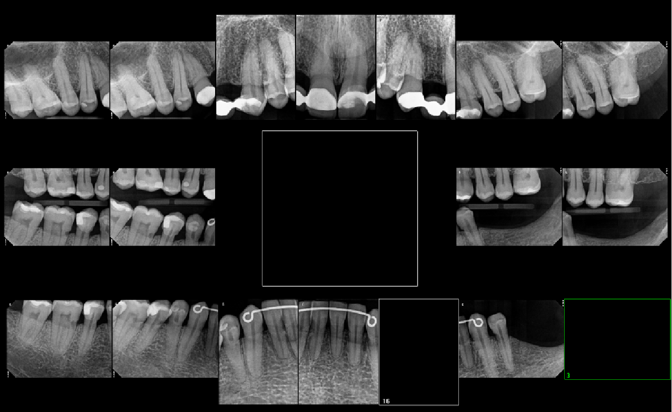 Teeth Detection Object Detection Dataset By Mao Miao