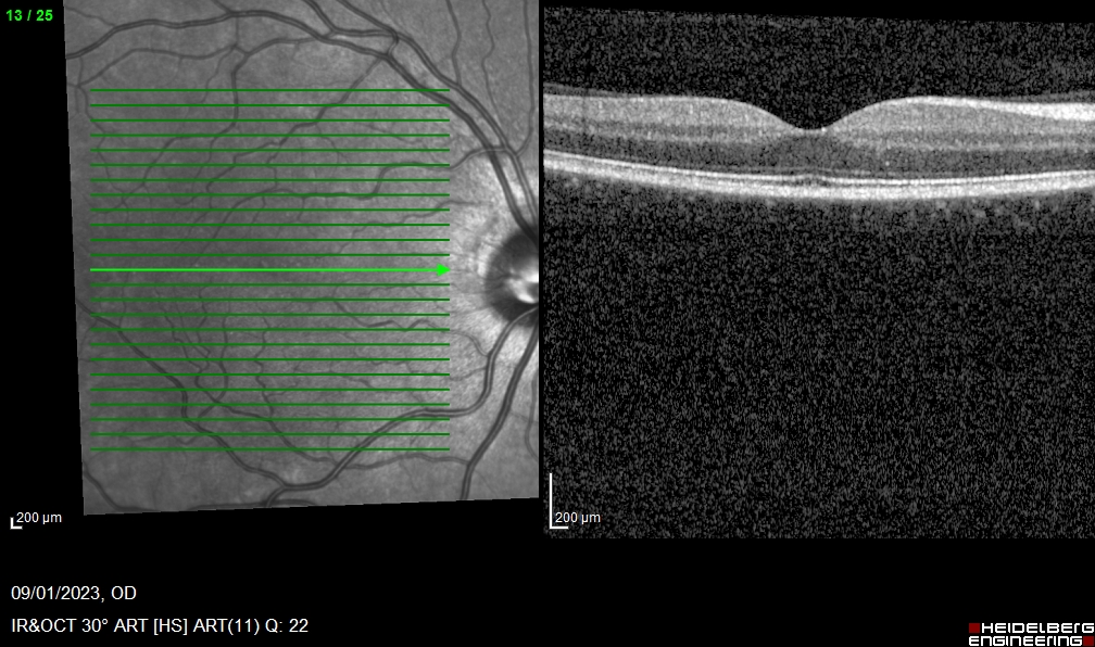 DMLA Object Detection Dataset and Pre-Trained Model by proj