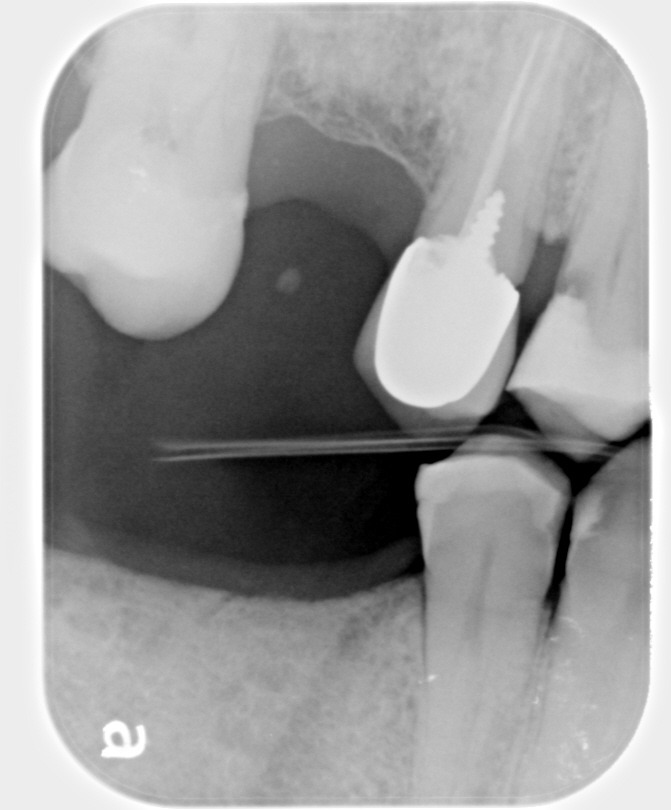 caries Object Detection Dataset by Corey Burton
