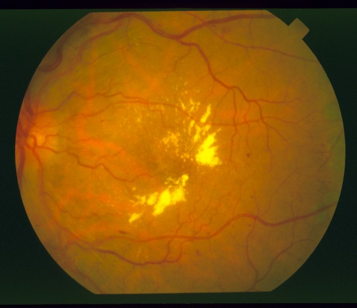 Predicting diseases by eye Object Detection Dataset and Pre-Trained ...