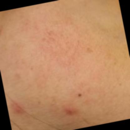 acne-classification Classification Dataset by pytorchenv