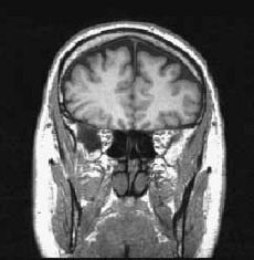 Brain Tumor Object Detection Dataset by Thesis