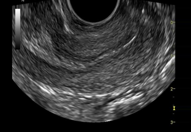 Pcos Object Detection Dataset By Vanessas