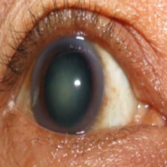 Cataract Detection Classification Dataset And Pre Trained Model By Fy Project