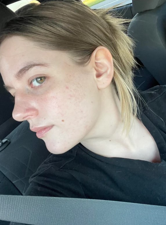 Acne Object Detection Dataset and Pre-Trained Model by Acne