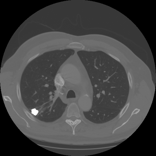 Nodule Severity Detection Object Detection Dataset And Pre Trained Model By Thesis