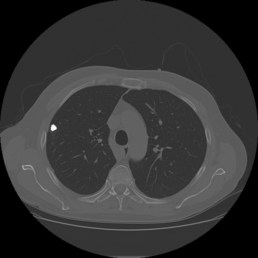 Nodule Severity Detection Object Detection Dataset V1 2023 01 04 6