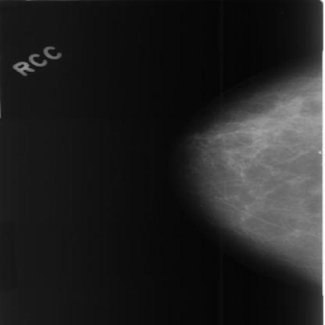 Cancer In Mammogram Object Detection Dataset V1 2023 12 10 10 43am By Thiago