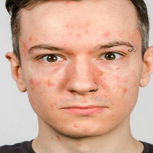 AcnePredictions Object Detection Dataset and Pre-Trained Model by FYP