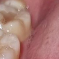 caries detection Object Detection Dataset by caries