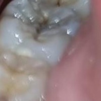 caries detection Object Detection Dataset by caries