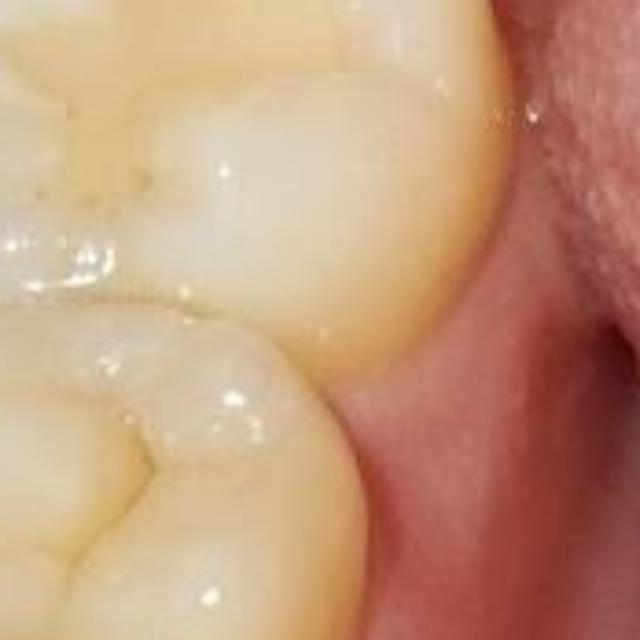 Caries Detection Object Detection Dataset V1 2023 04 24 1 33pm By Caries