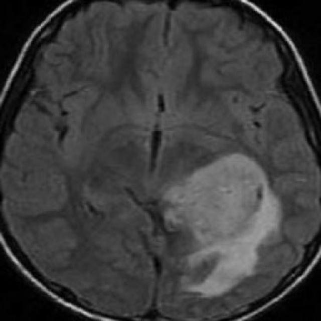 Brain Tumor Detection Dataset Object Detection Dataset by stuti thakur