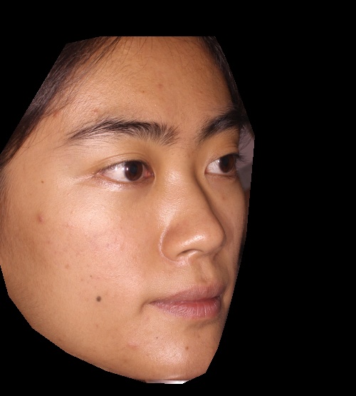 acne Object Detection Dataset and Pre-Trained Model by acne