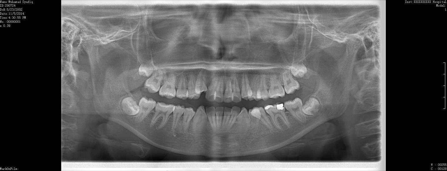 teeth-detection Instance Segmentation Dataset and Pre-Trained Model by teethdetector