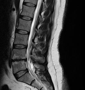 Herniation Classification Dataset by Harsha