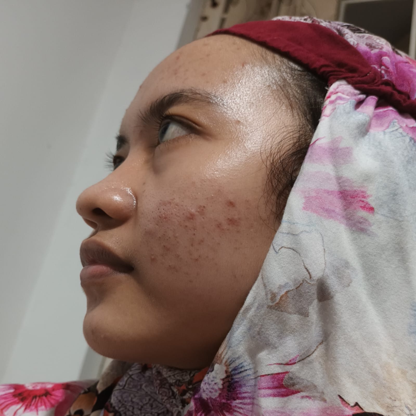 Jenis Jerawat Object Detection Dataset and Pre-Trained Model by BRI ...