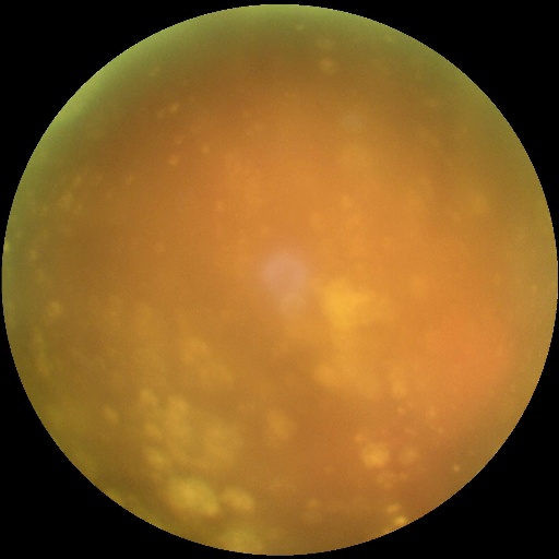 catract_glaucoma_detection Object Detection Dataset by Cataract glaucom