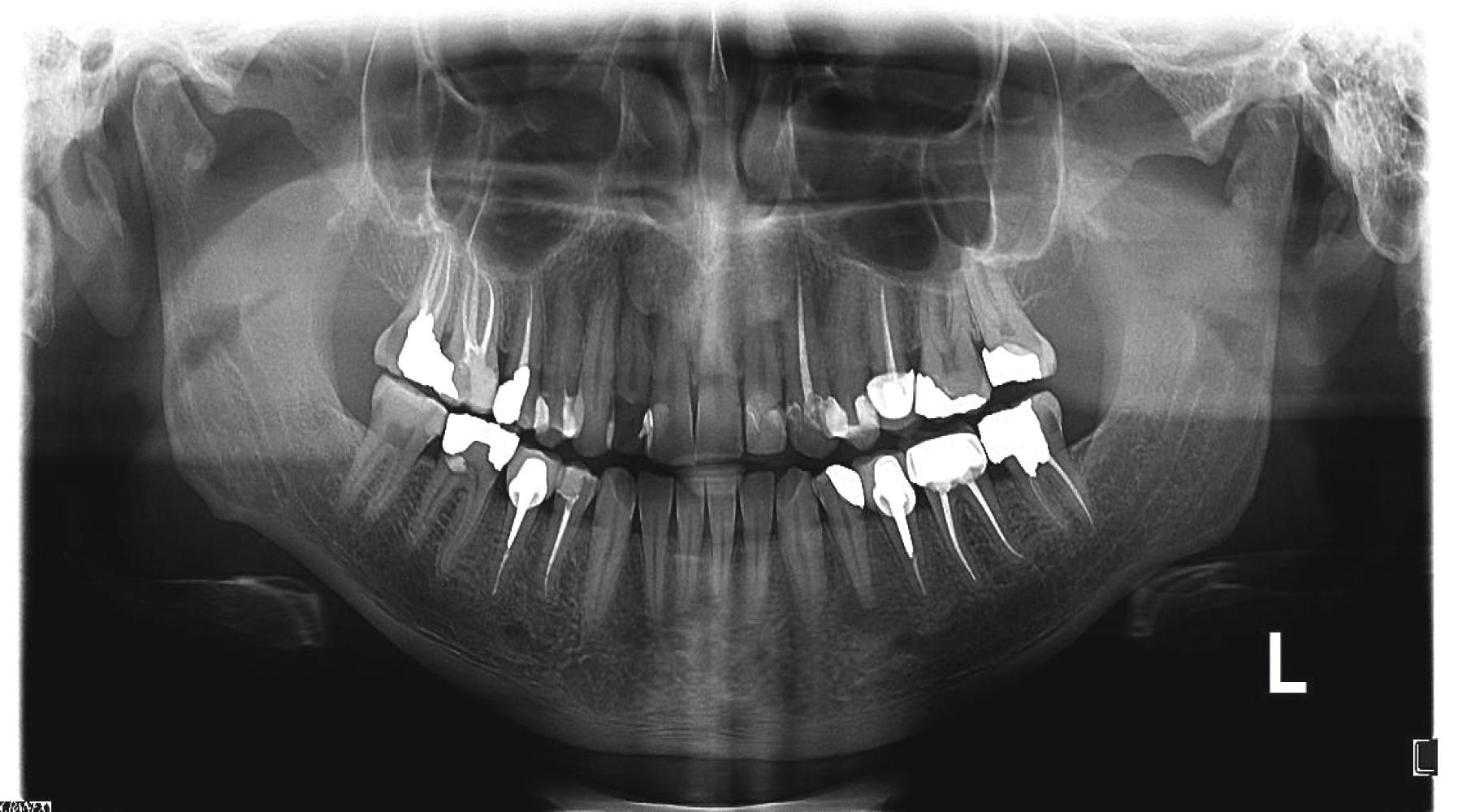Tooth Segmentation Instance Segmentation Dataset By Tooth Instance Segmentation 